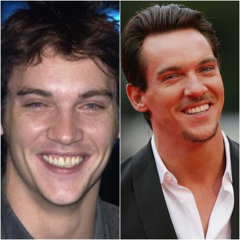 50+ Celebs Who Paid a Small Fortune on Dentalcare to Improve Their ...