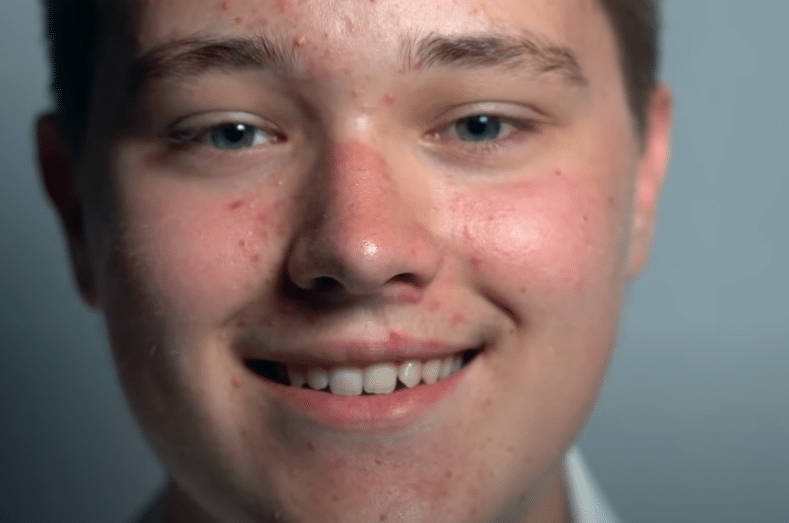 He Was Always Bullied And Called ‘Rabbit Boy’. But A Few Years Later He ...