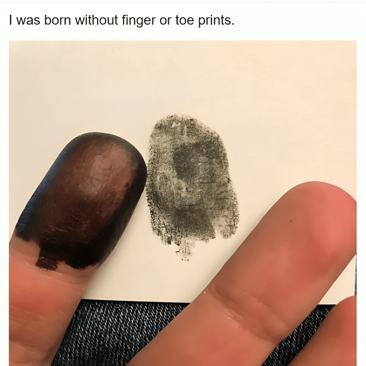 People Share Their Most Intriguing Body Abnormalities – Page 33